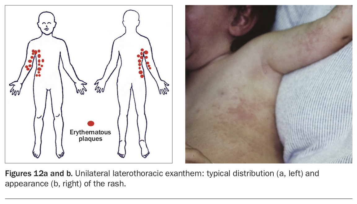 Viral exanthems: unravelling viral rashes | Medicine Today Viral exanthems: unravelling viral rashes | Medicine Today